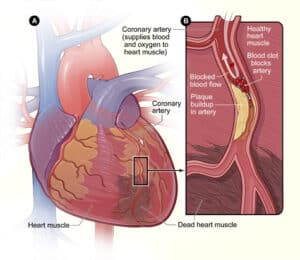 Coronary Artery Spasm: A Comprehensive Understanding