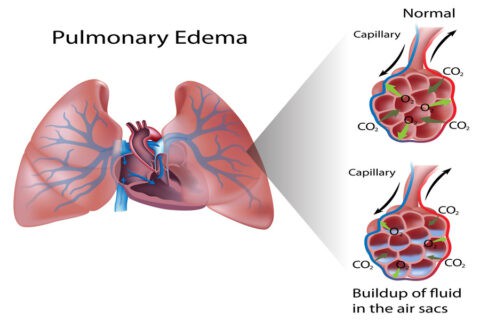 Pulmonary Edema: Causes, Symptoms, and Prevention