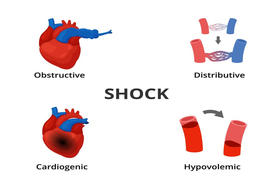 Cardiogenic Shock A Comprehensive Overview Longmore Clinic