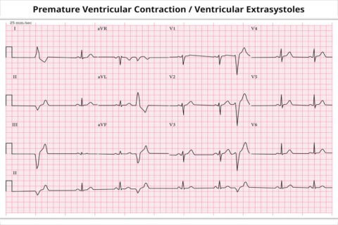 Premature Ventricular Contractions (PVCs) | Longmore Clinic